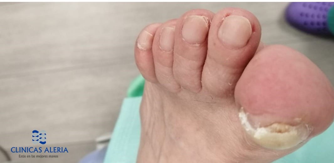 DIAGNÓSTICO Y TRATAMIENTO DEL HELOMA SUBUNGUEAL | Clínicas Aleria ...